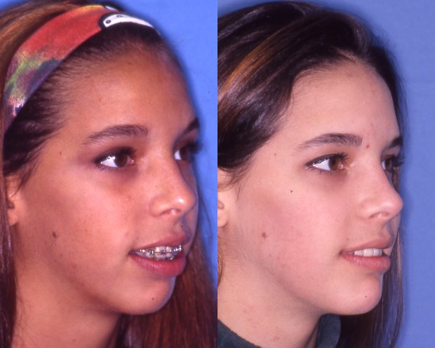 Long Face Syndrome Surgery Before And After