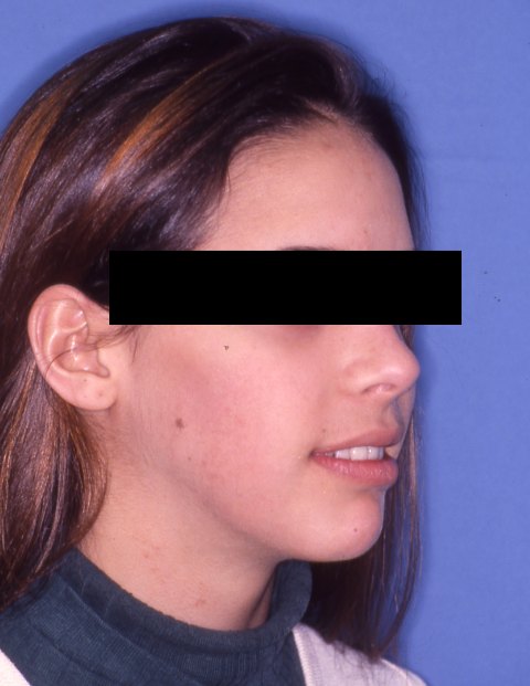 Jaw Surgery Gallery Alpharetta | Before & After Jaw Surgery Photos