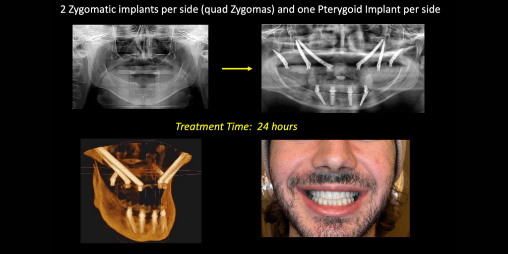 Zygomatic Implants Alpharetta, Atlanta | Graftless dental Implants