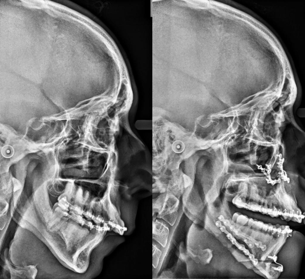 Sleep Apnea Alpharetta | Snoring | Sleep Apnea Symptoms & Treatment