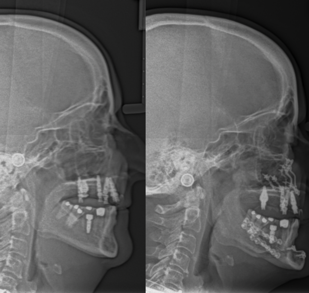 Sleep Apnea Alpharetta | Snoring | Sleep Apnea Symptoms & Treatment