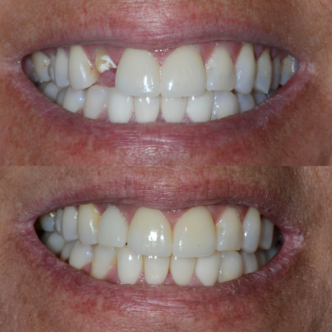 Immediate New Tooth Alpharetta | Replace Broken or Missing Tooth