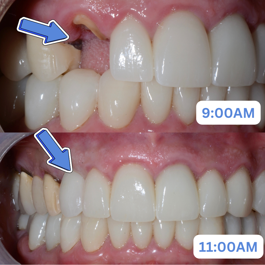 Immediate New Tooth Alpharetta | Replace Broken or Missing Tooth