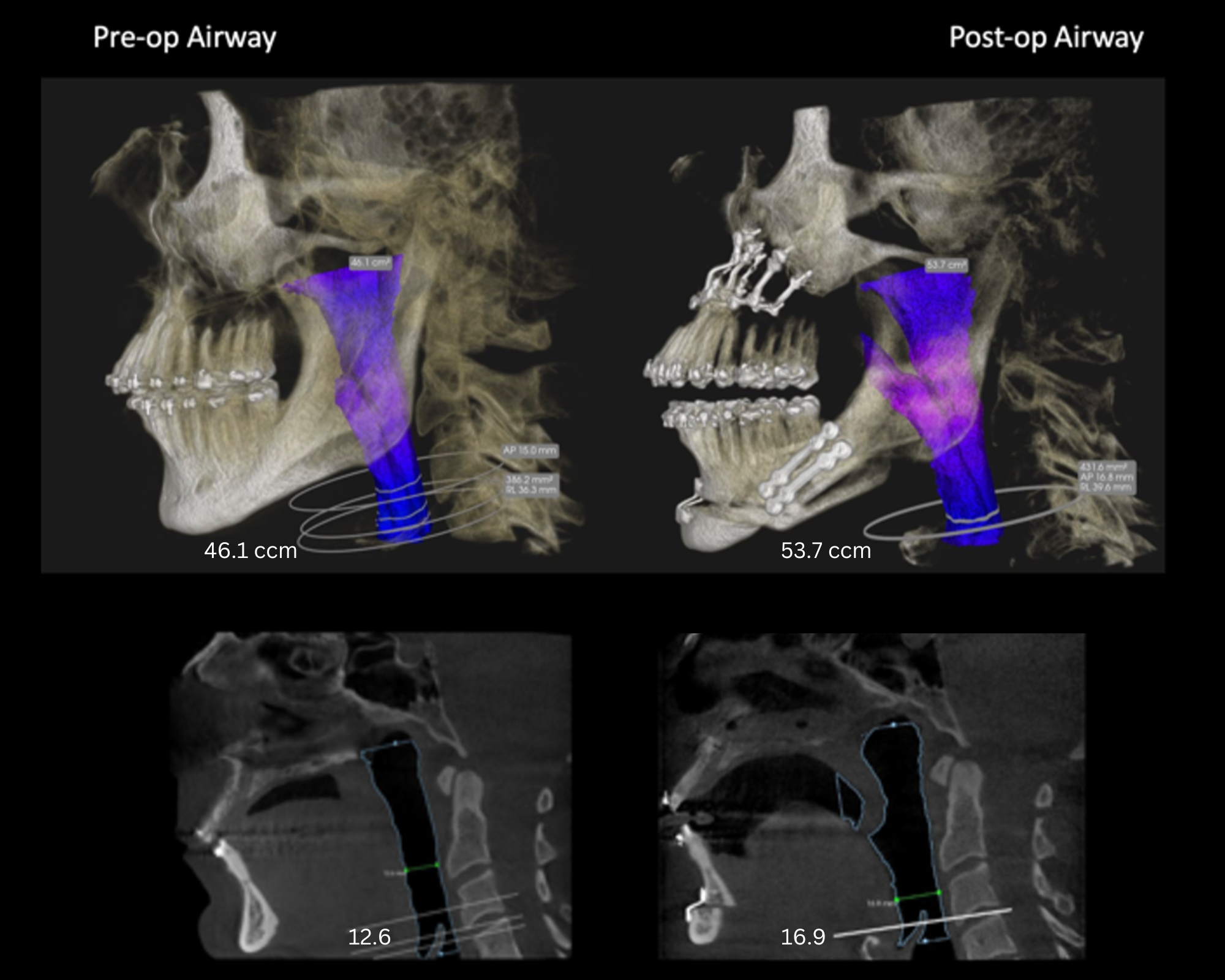 Sleep Apnea Alpharetta | Snoring | Sleep Apnea Symptoms & Treatment