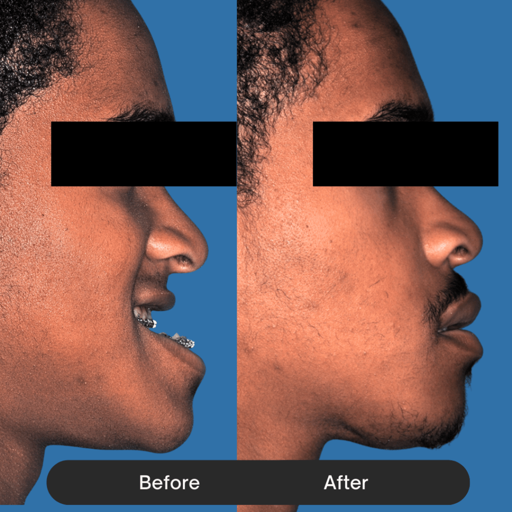 Jaw Surgery Gallery Alpharetta | Before & After Jaw Surgery Photos
